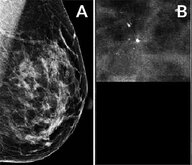 Macrocalcifications (e.g., calcified cyst) Coarse popcorn-like ...