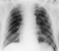 Point-of-care ultrasound for pneumothorax ( POCUS ) [9]