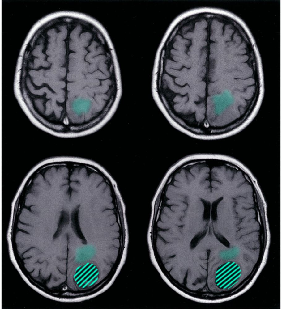 Abnormal Brain Mri Without Contrast