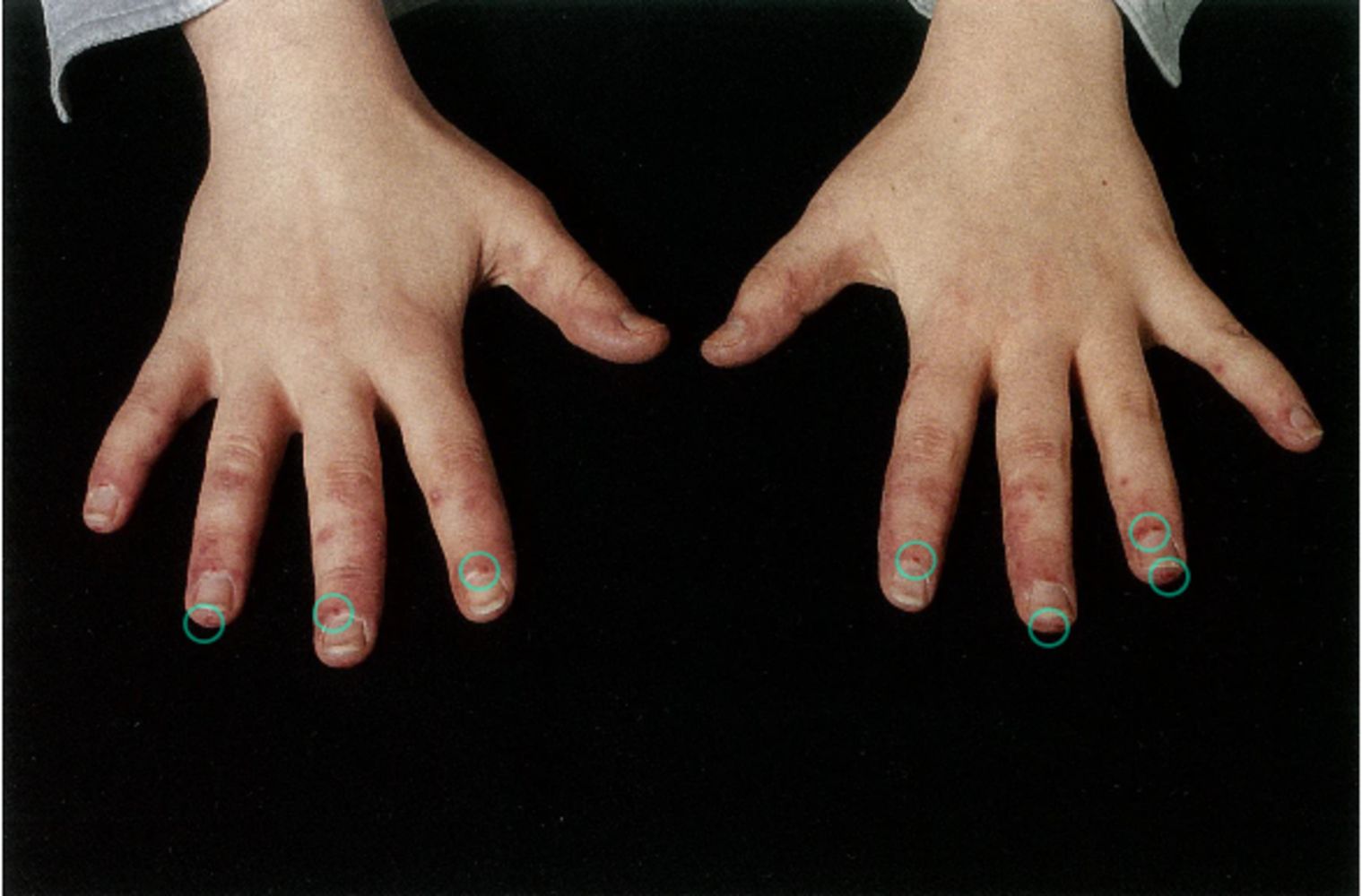 Lupus Swelling Of Finger Systemic Lupus Erythematosus Knowledge