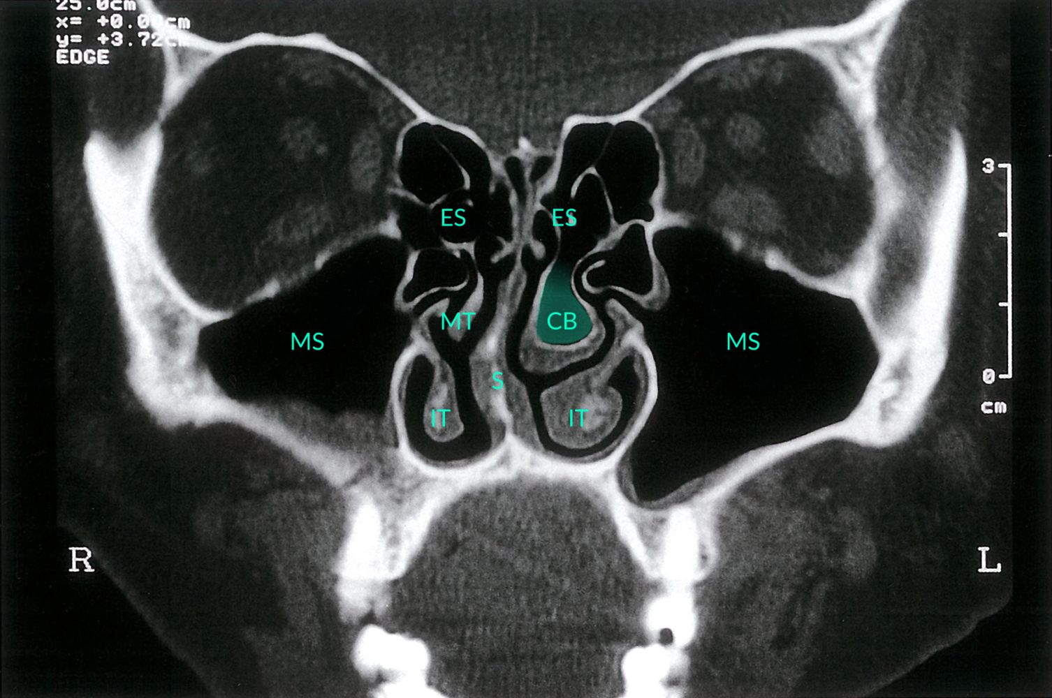 Boggy Edematous Nasal Turbinates