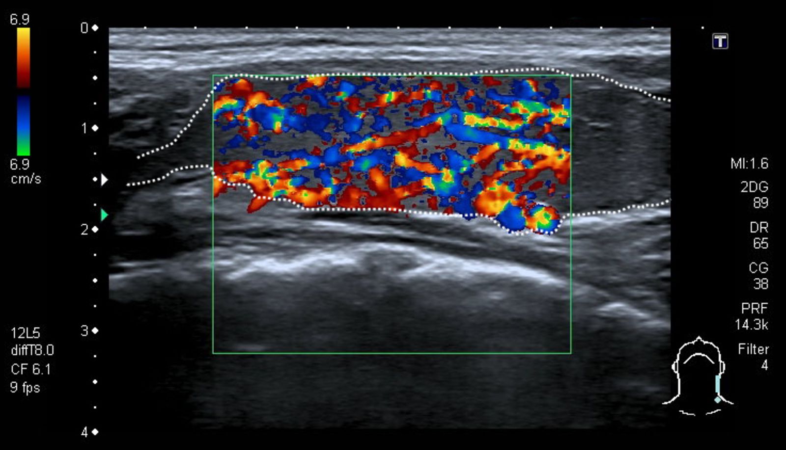 Graves Disease Thyroid Ultrasound