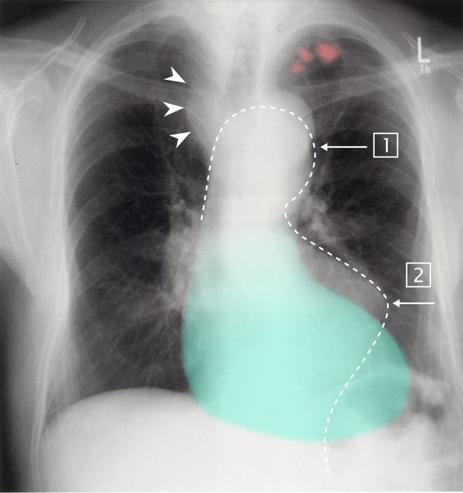 Thoracic Aortic Aneurysm Xray