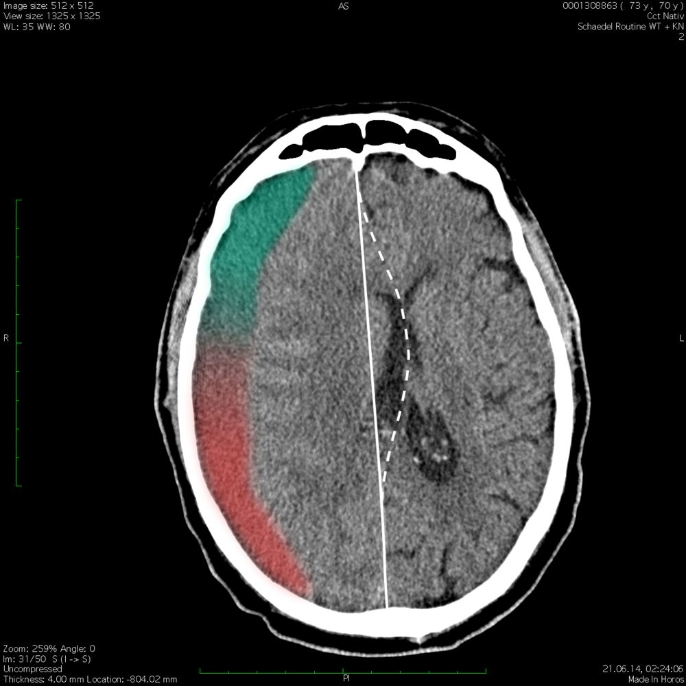 Subdural Haematoma With Midline Shift