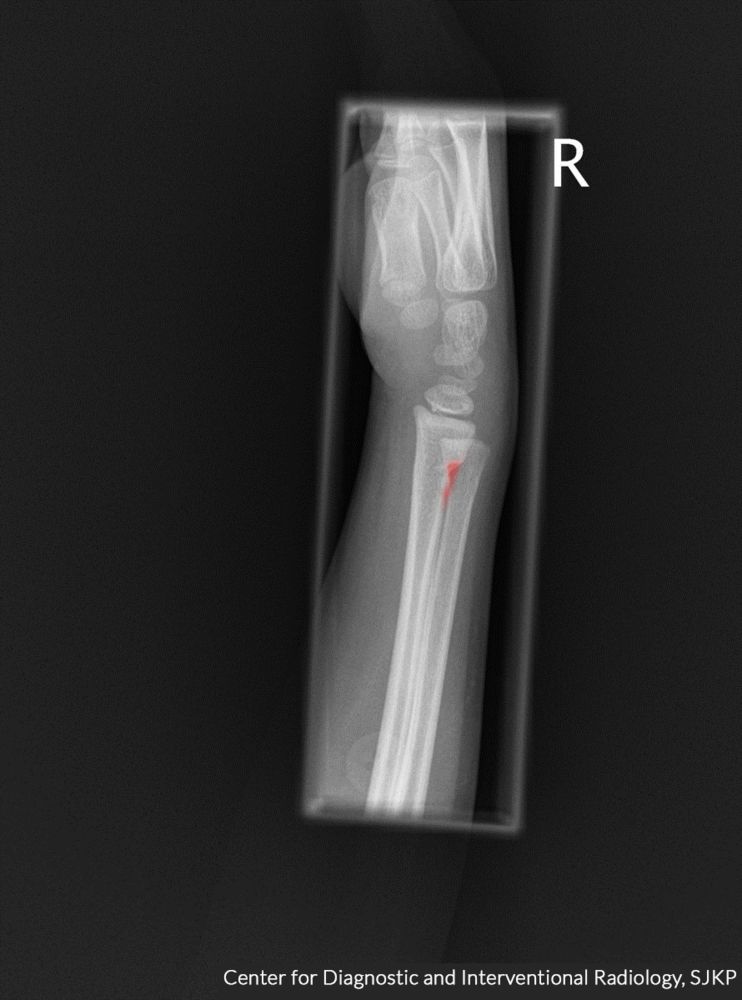 Greenstick Fracture X Ray