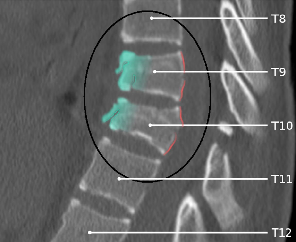 T12 Burst Fracture Mri