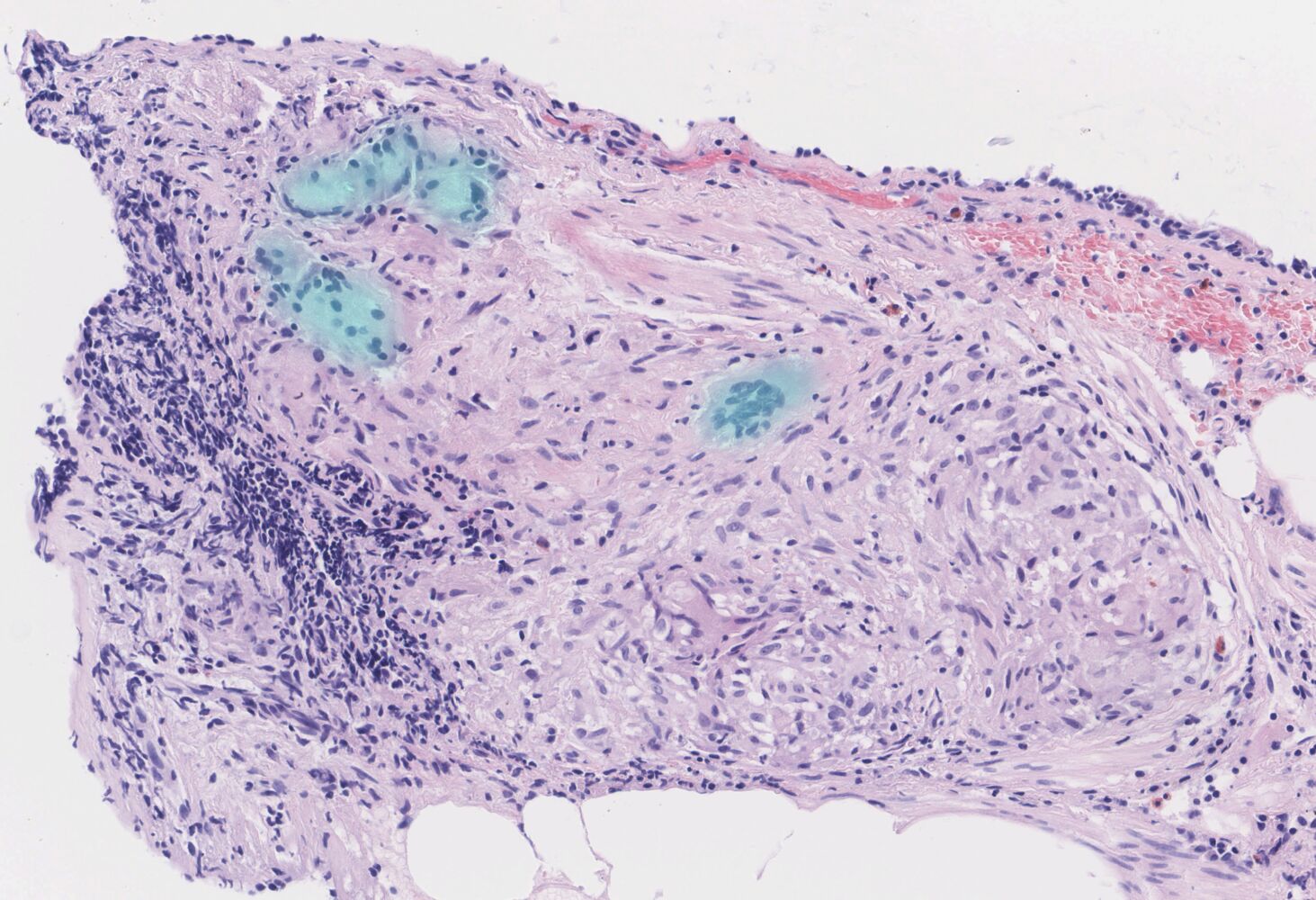Lupus Pernio Histology