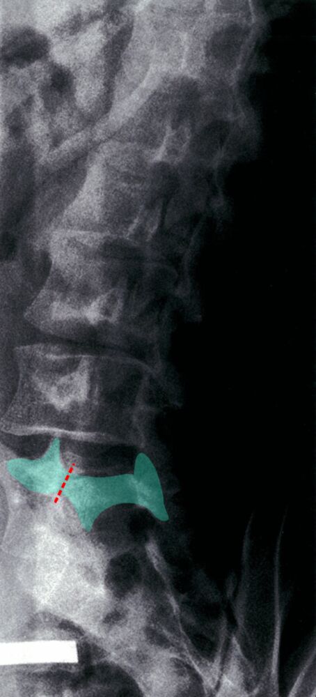 Spondylolisthesis X Ray Scotty Dog