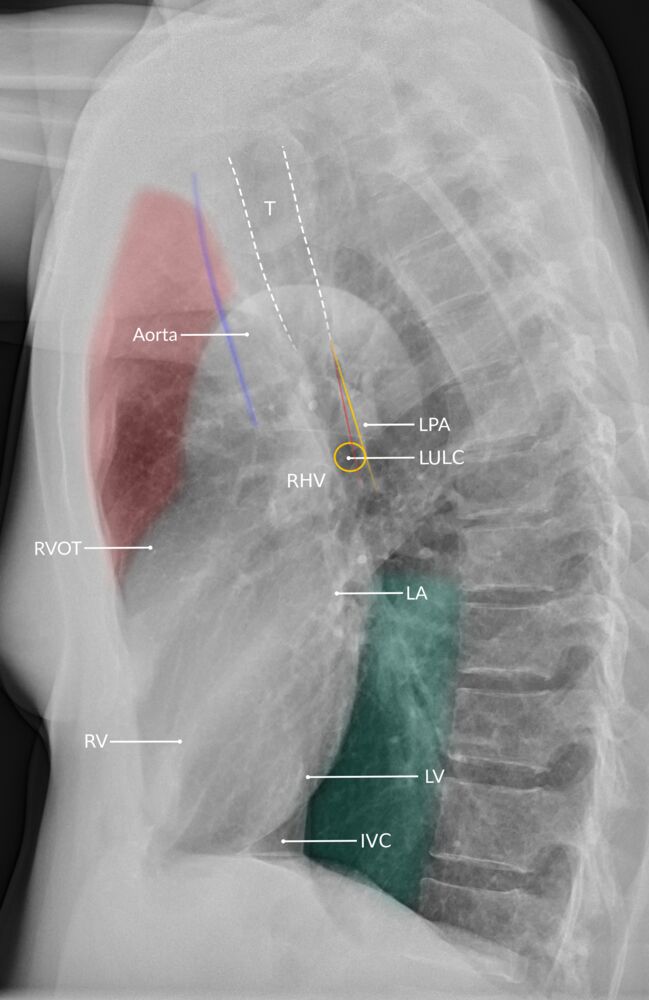 Lateral Chest X Ray Anatomy Chest – Undergraduate Diagnostic Imaging