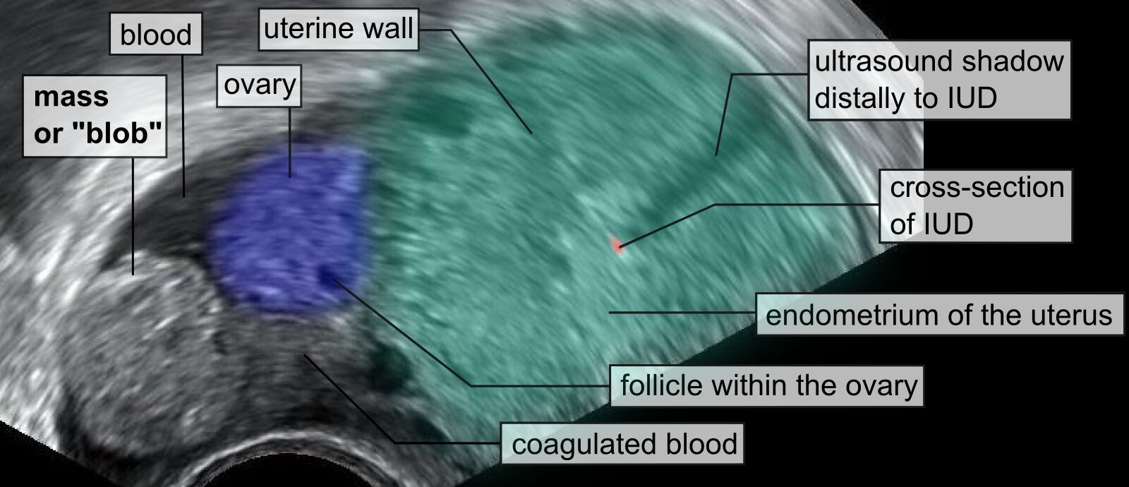 Ectopic Pregnancy Usmle Step 2 Review Youtube