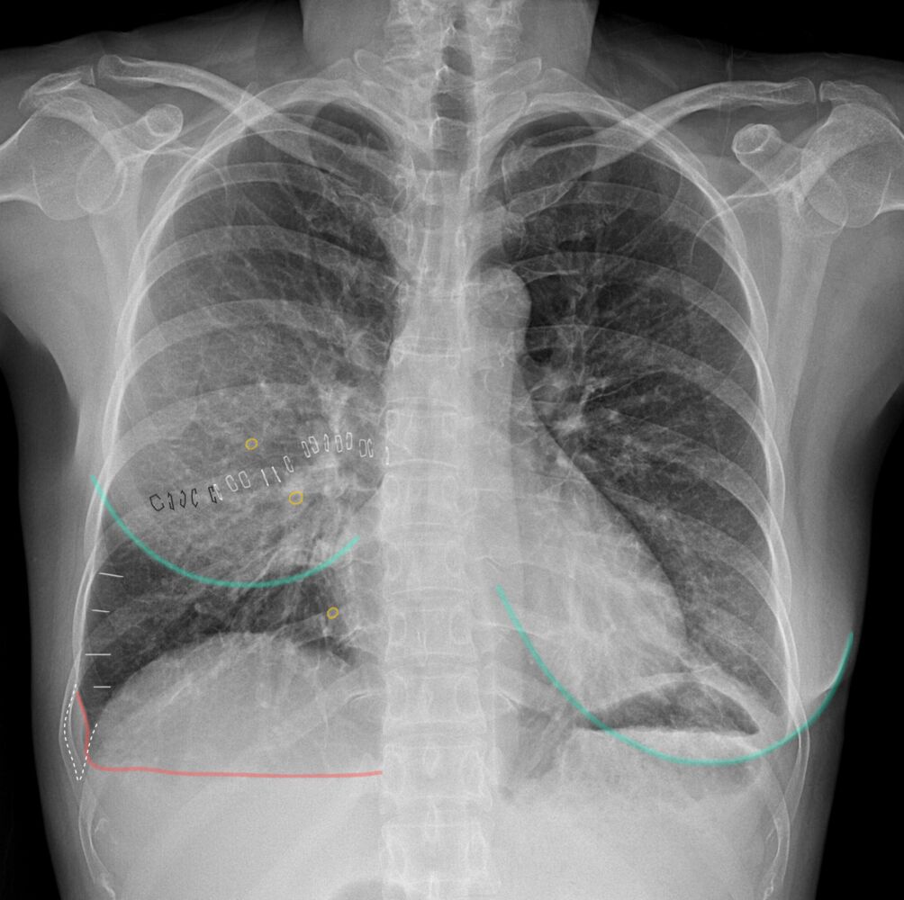 Chest Xray Pleural Effusion