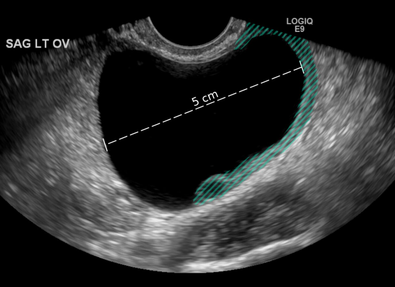 Graafian Follicle Ultrasound Graafian Follicle Ultrasound