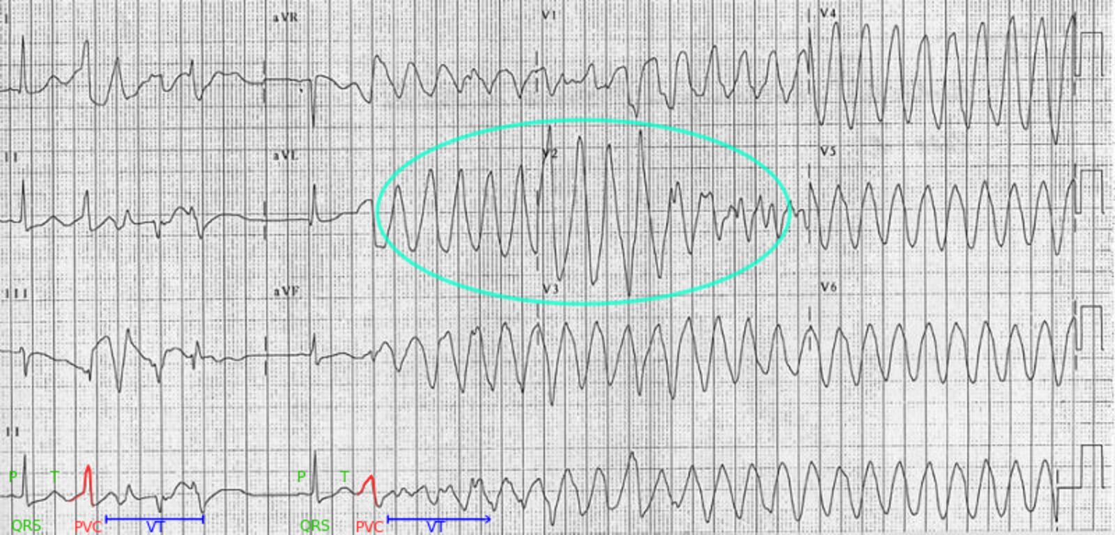 Pulseless Ventricular Tachycardia Ecg Pulseless Ventricular Tachycardia Ecg
