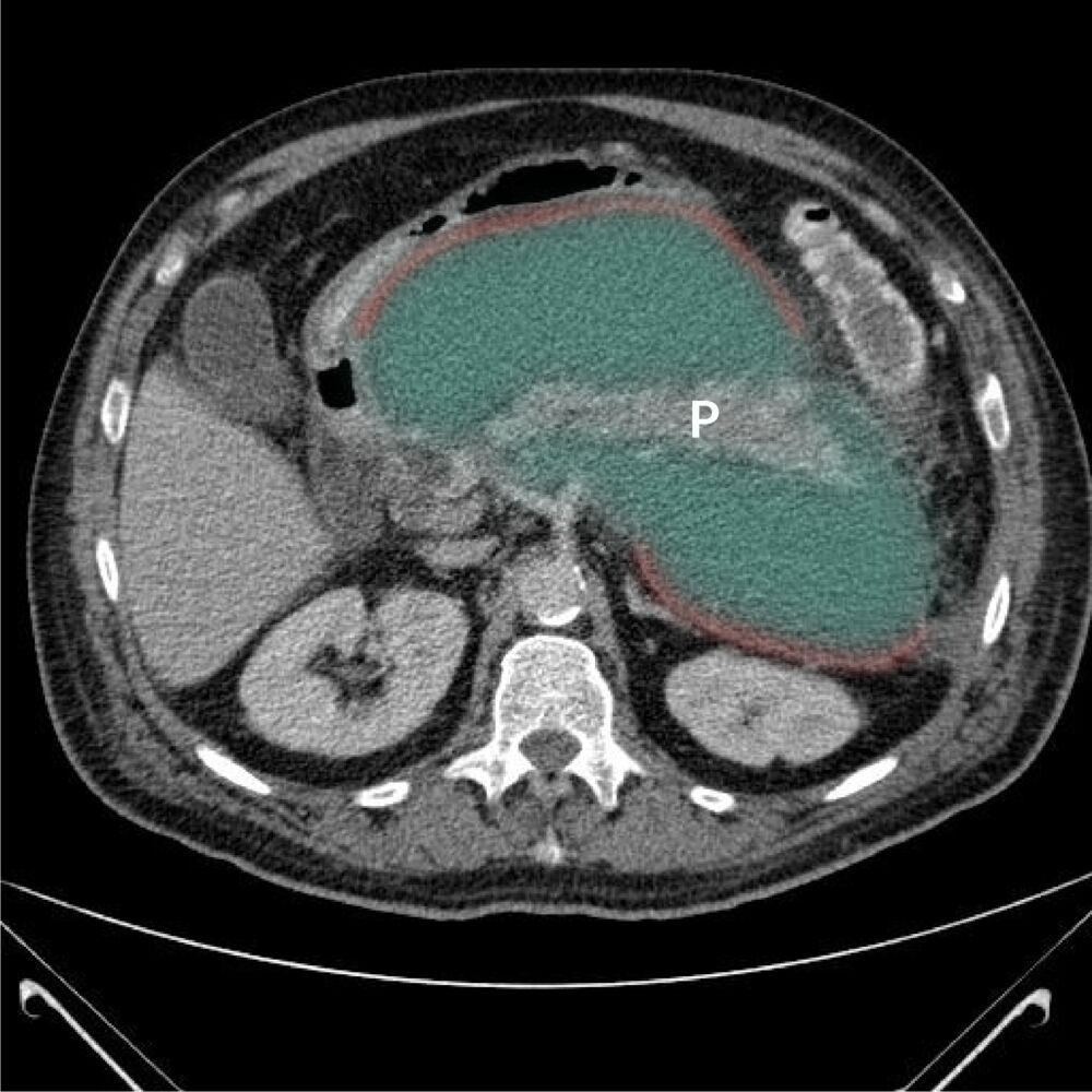 Chain Of Lakes Pancreatitis