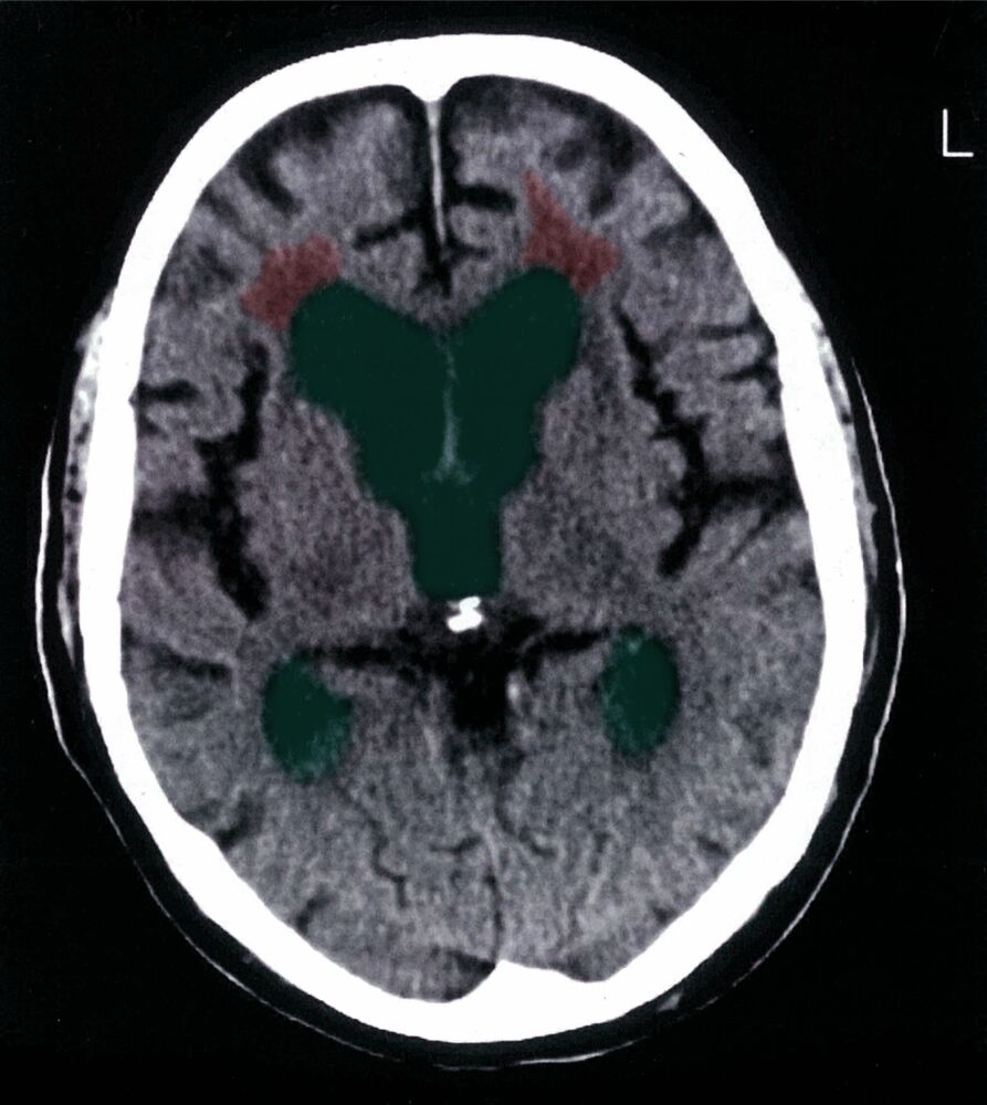 Normal Pressure Hydrocephalus Ct