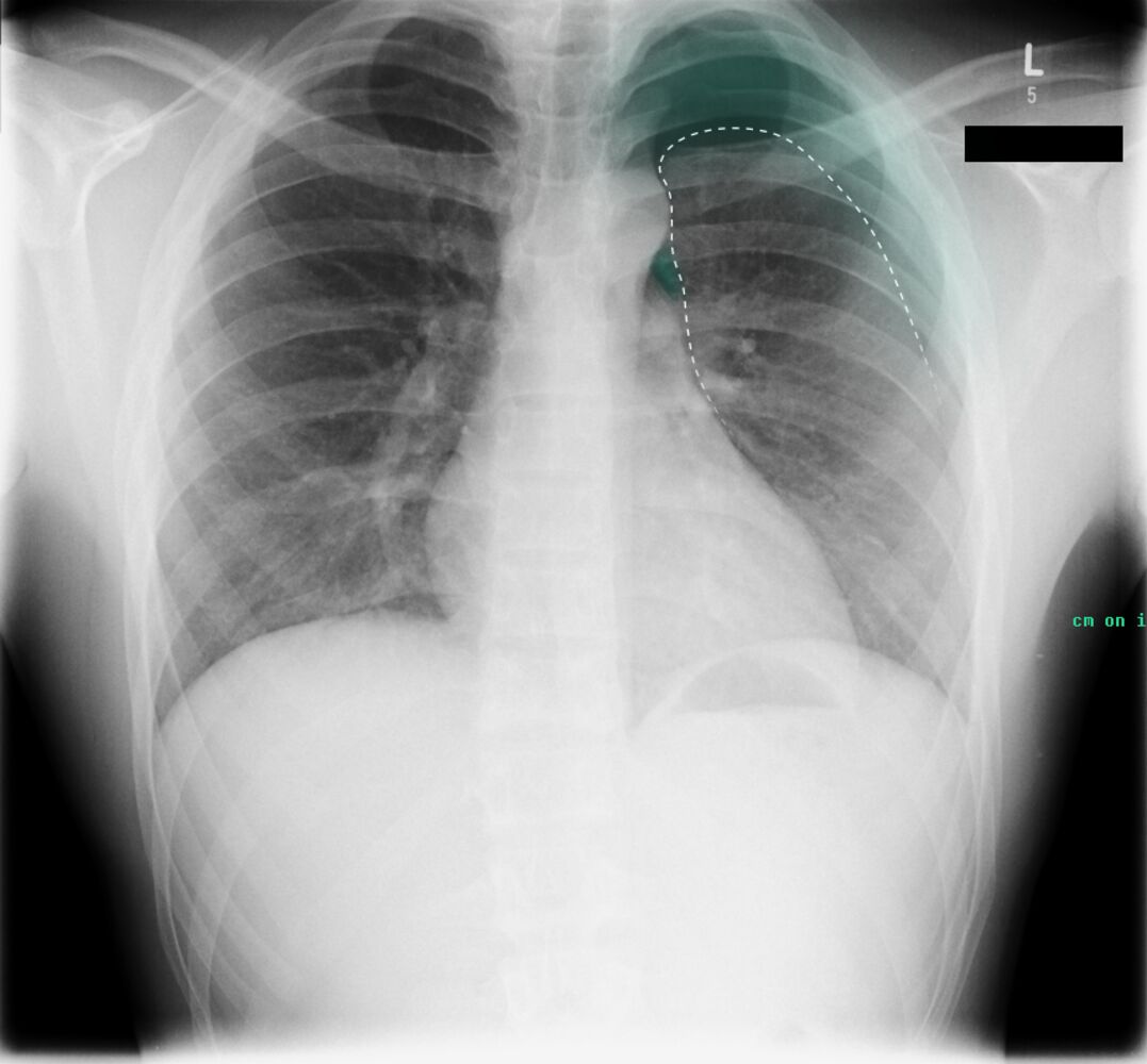 Pneumothorax Knowledge AMBOSS 51 OFF