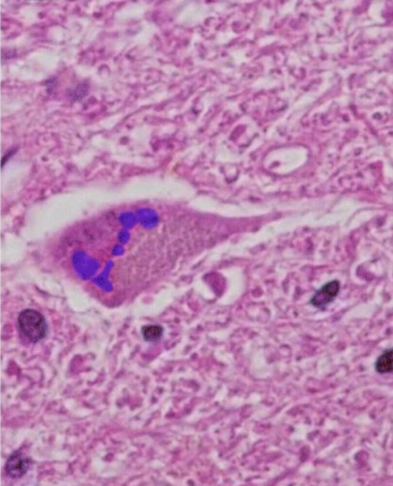 Amyotrophic Lateral Sclerosis Histology Frontiers | Analysis Of