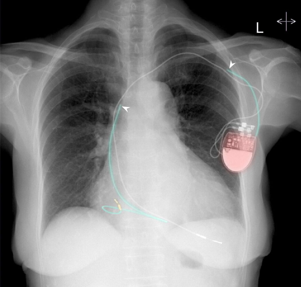Biventricular Pacemaker Chest X Ray Cardiac Resynchronization Therapy