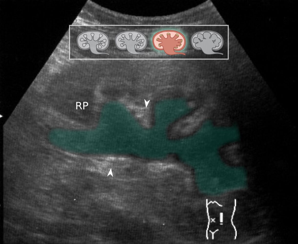 Nephrolithiasis Amboss