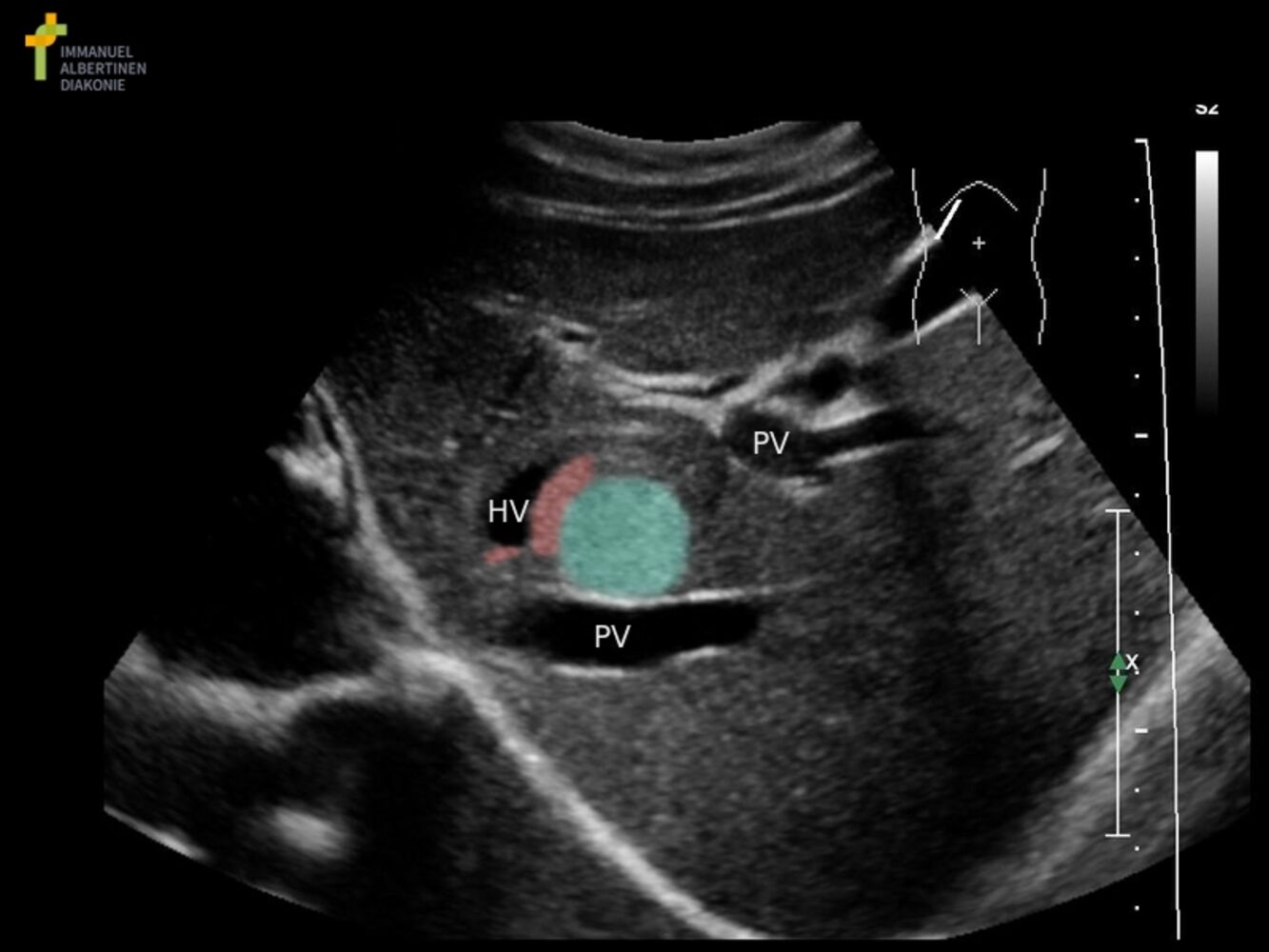 Transverse Liver Ultrasound Diaphragm