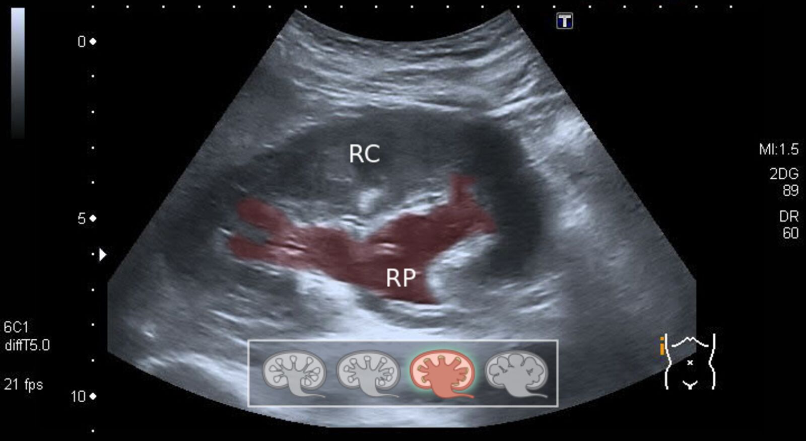 Nephrolithiasis Amboss