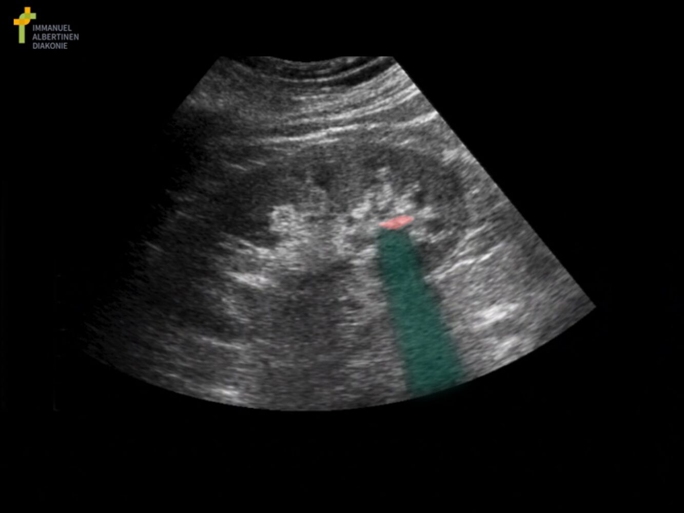 What Do Kidney Stones Look Like On Ultrasound