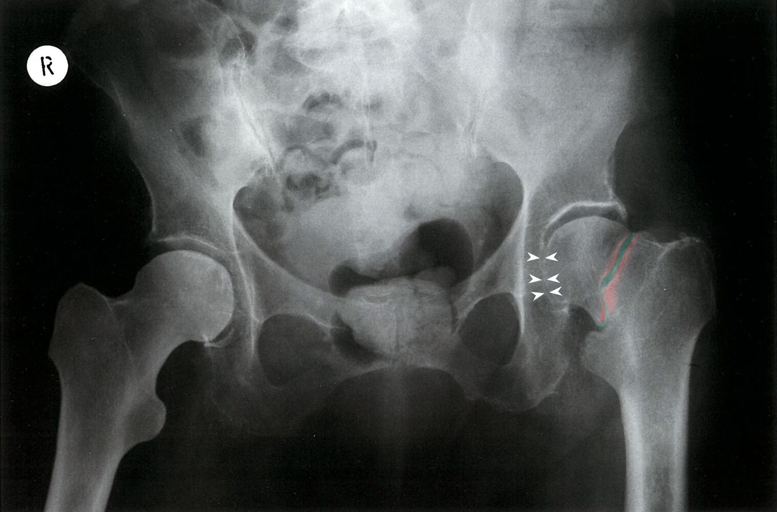 Hip Fracture X Ray