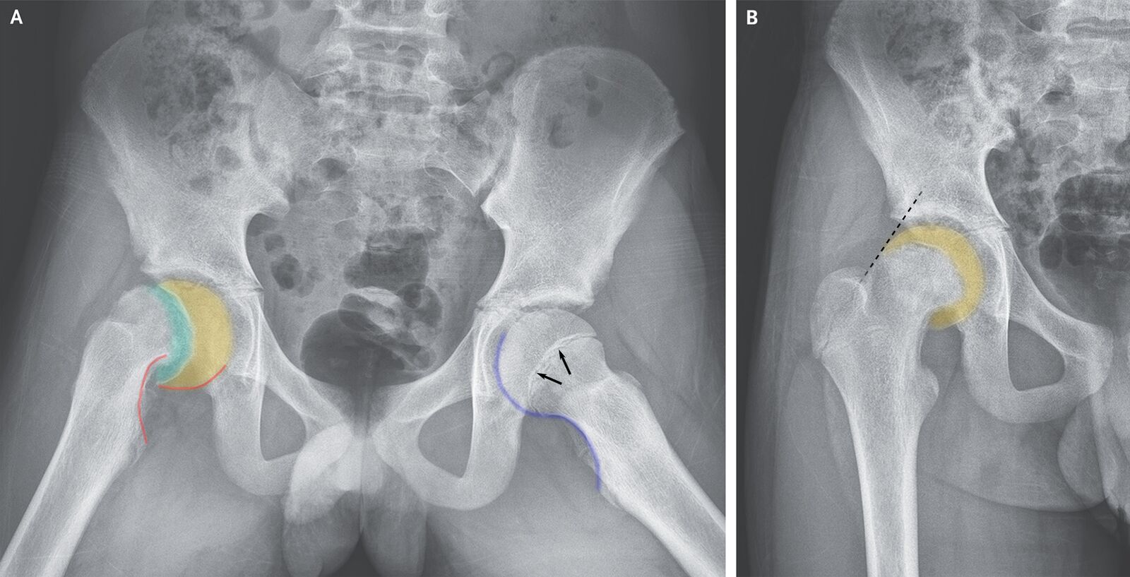 Slipped Capital Femoral Epiphysis Kleins Line The Child With A Limp