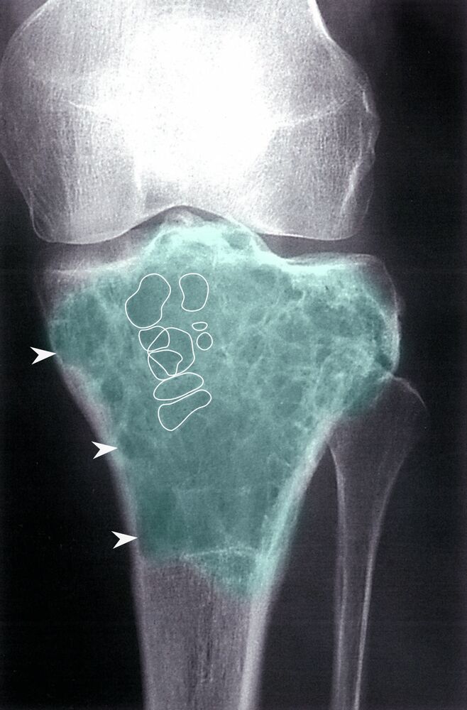Benign Tumor Of Bone