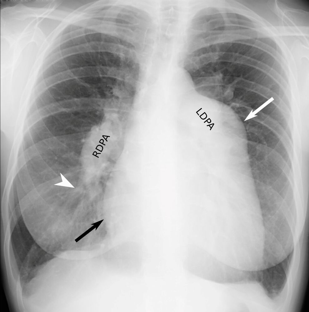 Pulmonary Hypertension X Ray Features